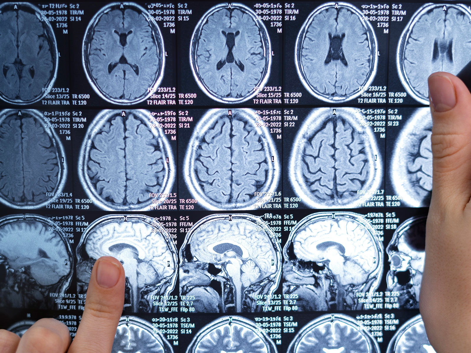 Estado de SP terá Comissão Técnica para desenvolver Linha de Cuidado ao AVC